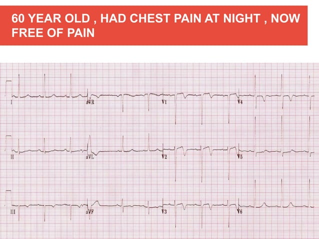 Ecg challenges | PPT