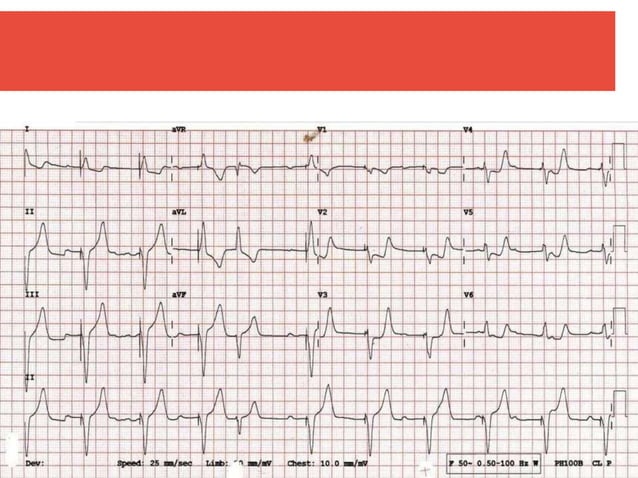 Ecg challenges | PPT