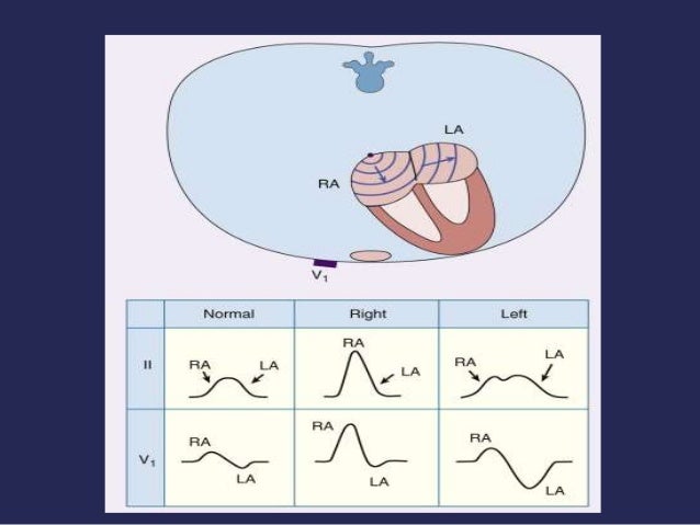 ECG diagnosis of chamber enlargement
