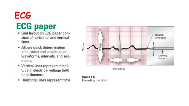 ECG changes, changes in intraventricular conduction | PPTX | Heart and ...