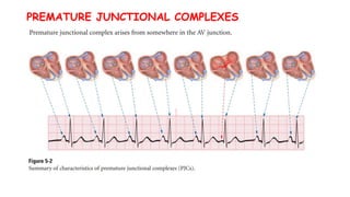 ECG changes, changes in intraventricular conduction | PPTX