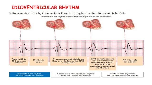ECG changes, changes in intraventricular conduction | PPTX | Heart and ...