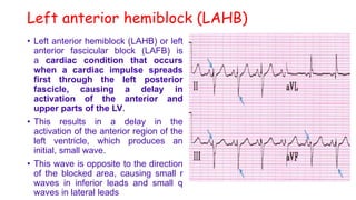 ECG changes, changes in intraventricular conduction | PPTX