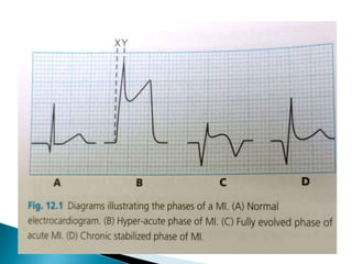 Ecg changes in mi | PPTX