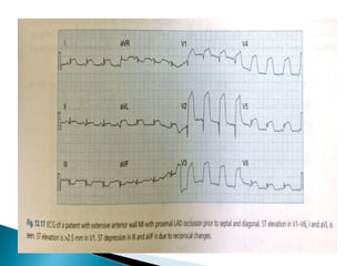 Ecg changes in mi | PPTX