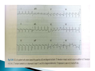 Ecg changes in mi | PPTX