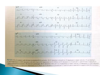 Ecg changes in mi | PPTX