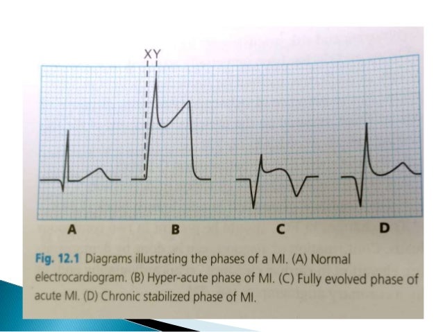 Ecg changes in mi