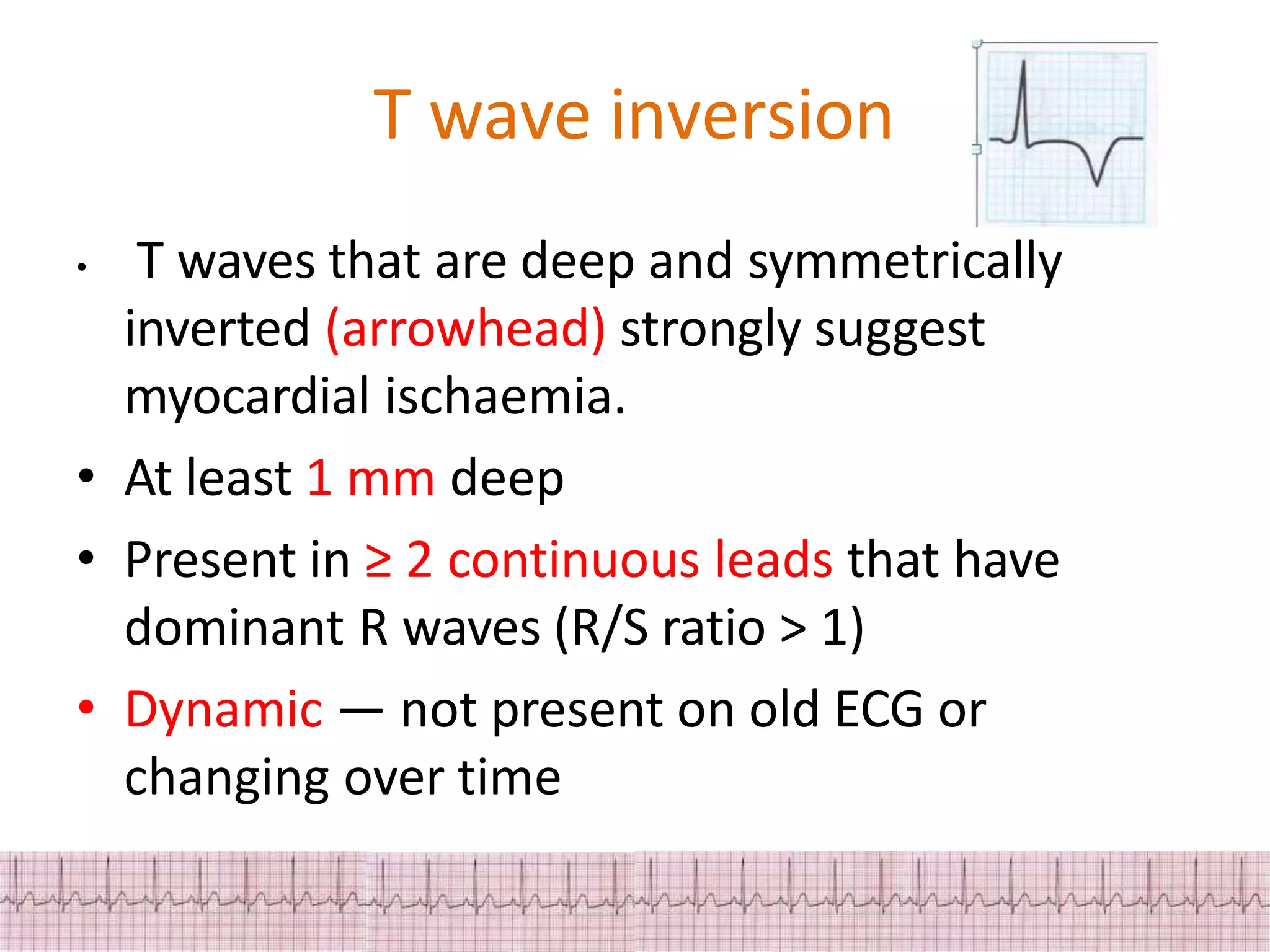 ECG Changes in Myocardial ischemia, myocardial infarction.pptx