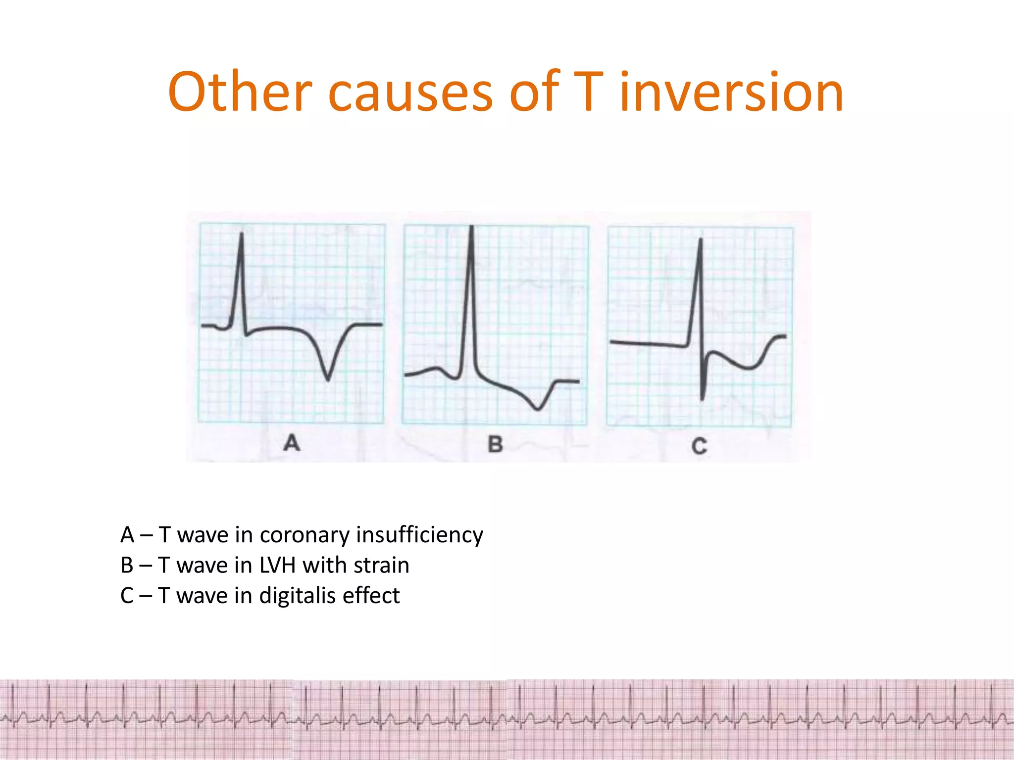 ECG Changes in Myocardial ischemia, myocardial infarction.pptx