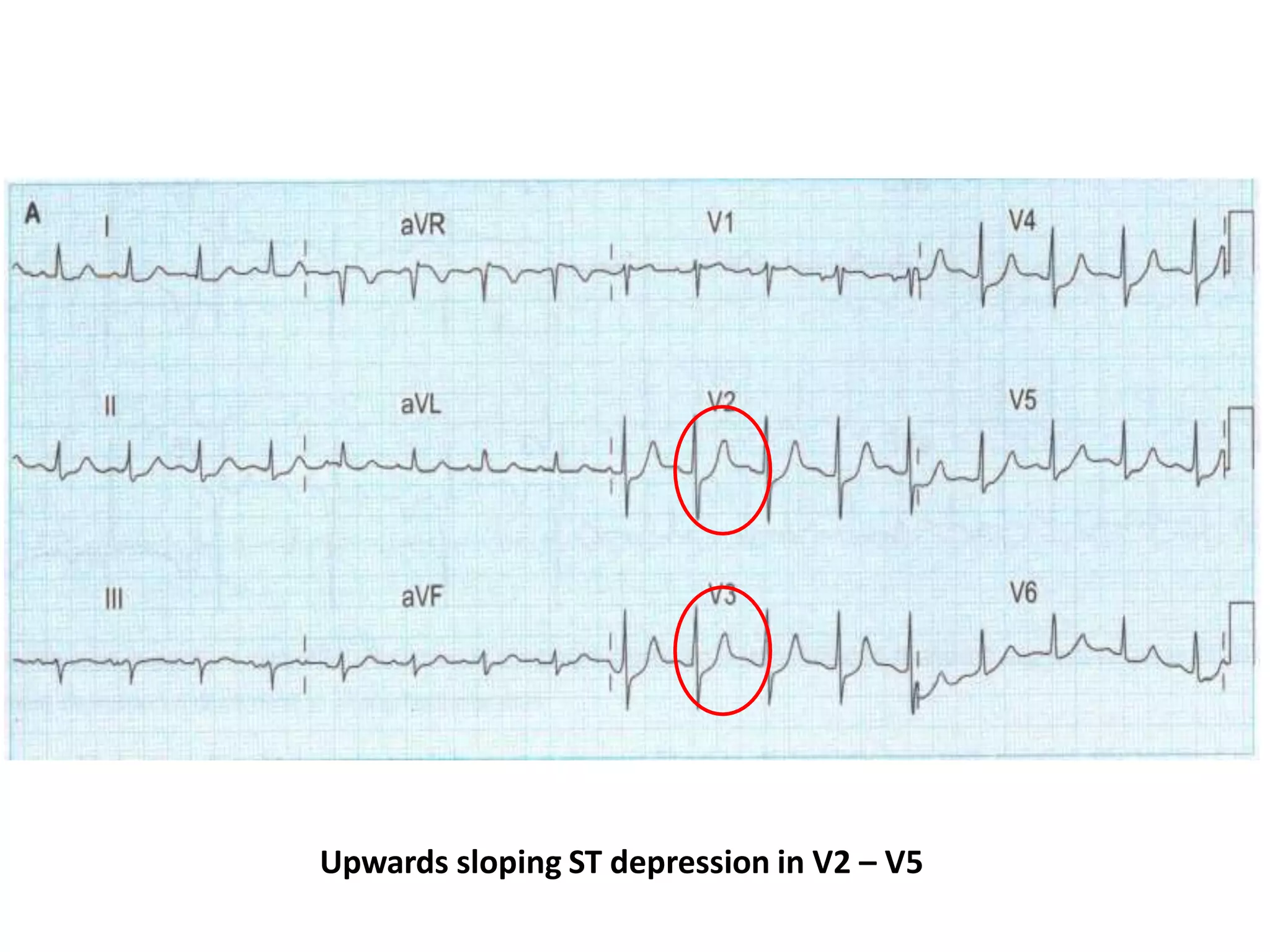 ECG Changes in Myocardial ischemia, myocardial infarction.pptx