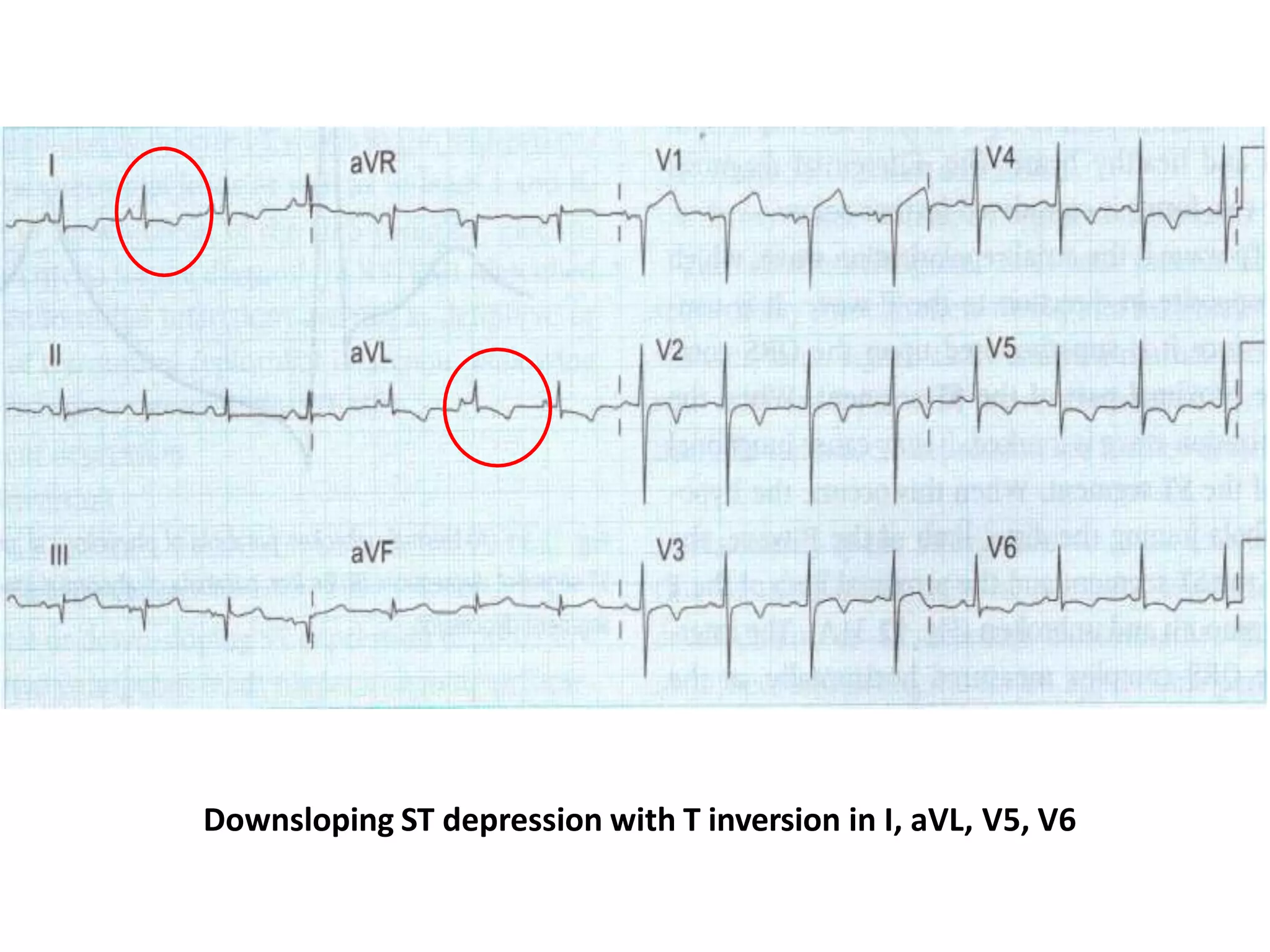 ECG Changes in Myocardial ischemia, myocardial infarction.pptx