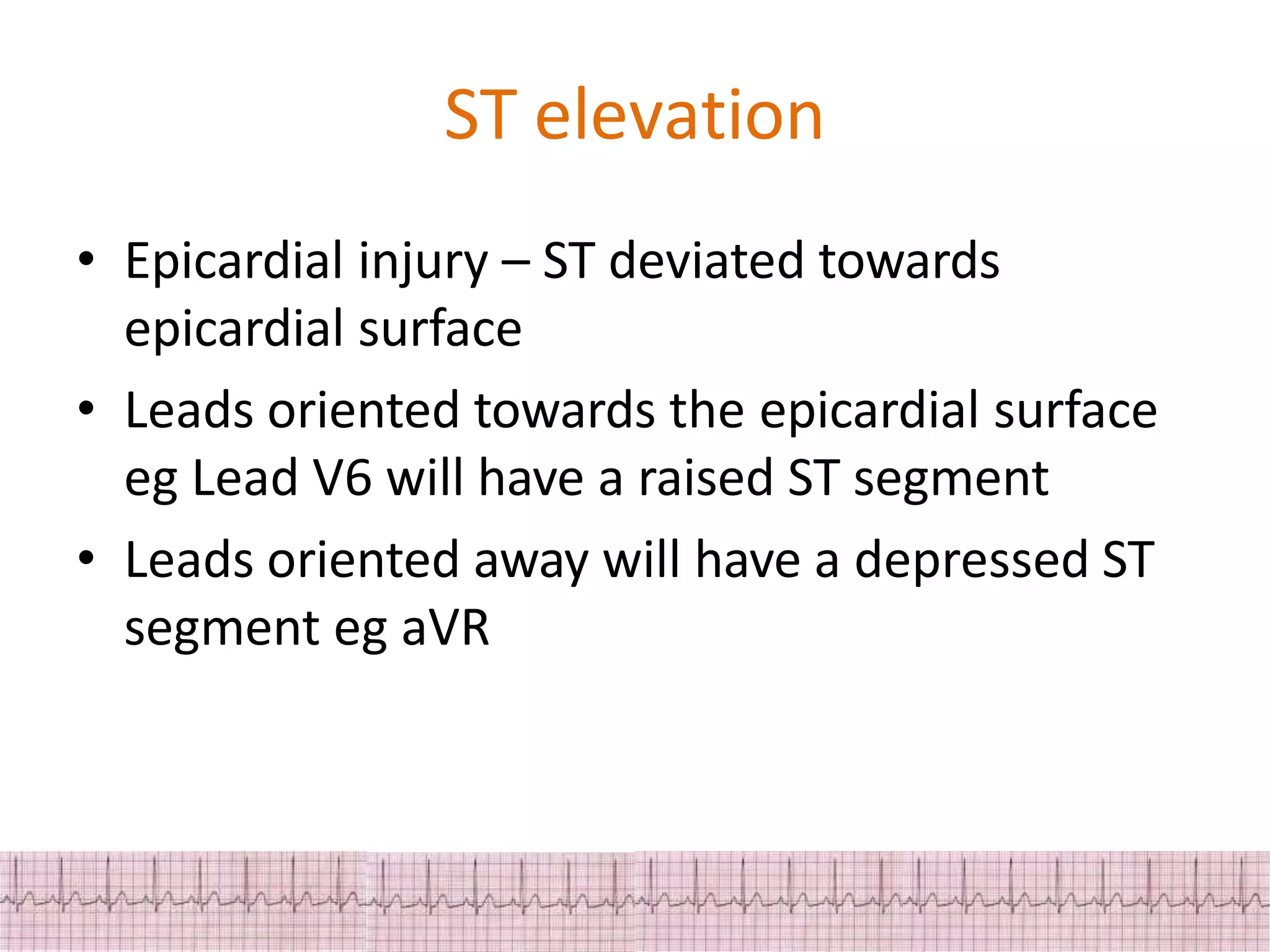ECG Changes in Myocardial ischemia, myocardial infarction.pptx