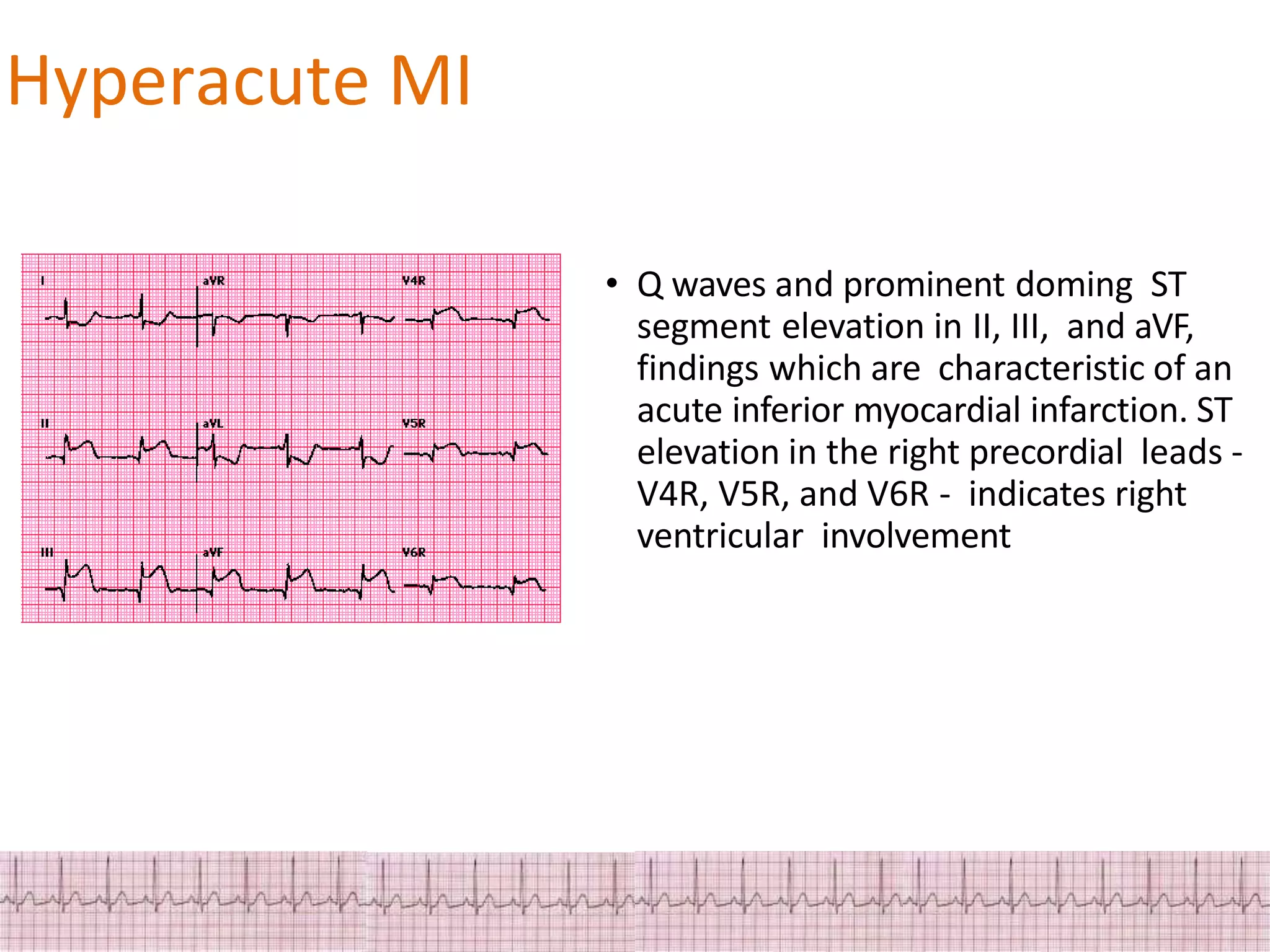 ECG Changes in Myocardial ischemia, myocardial infarction.pptx