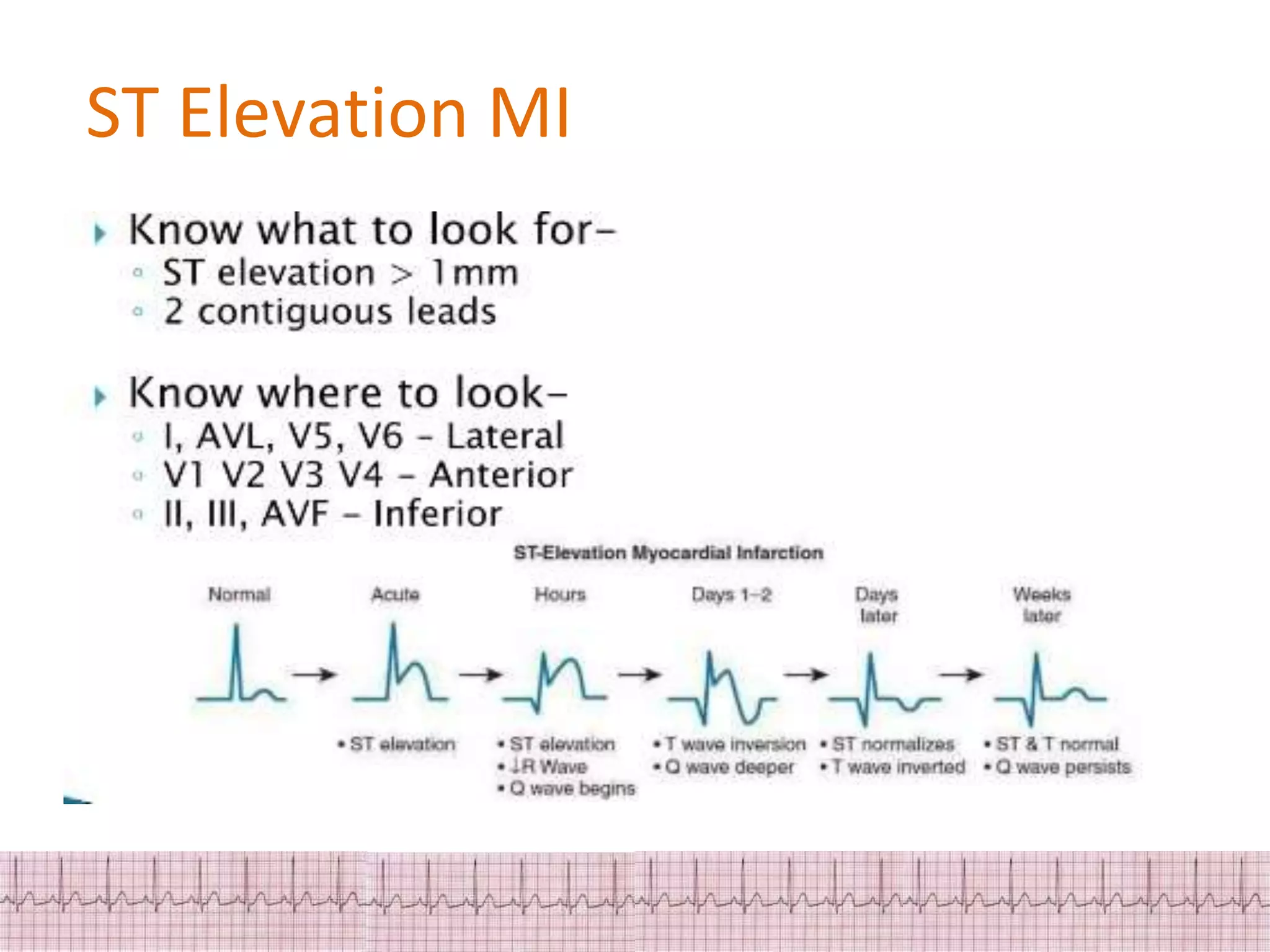 ECG Changes in Myocardial ischemia, myocardial infarction.pptx
