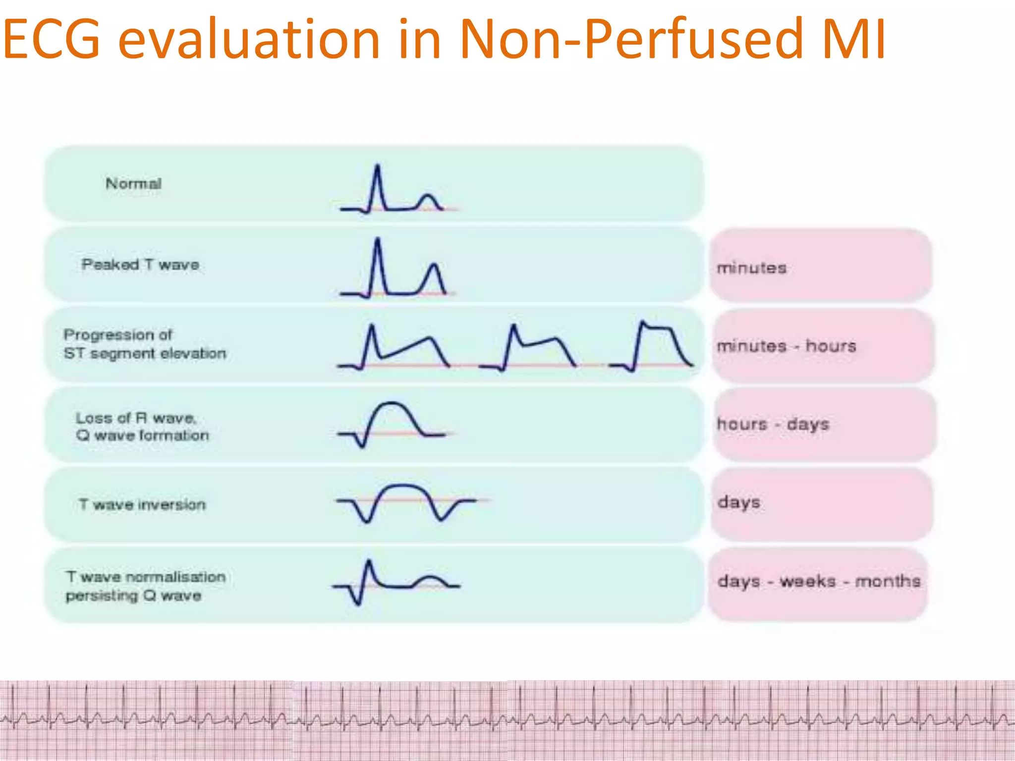 ECG Changes in Myocardial ischemia, myocardial infarction.pptx