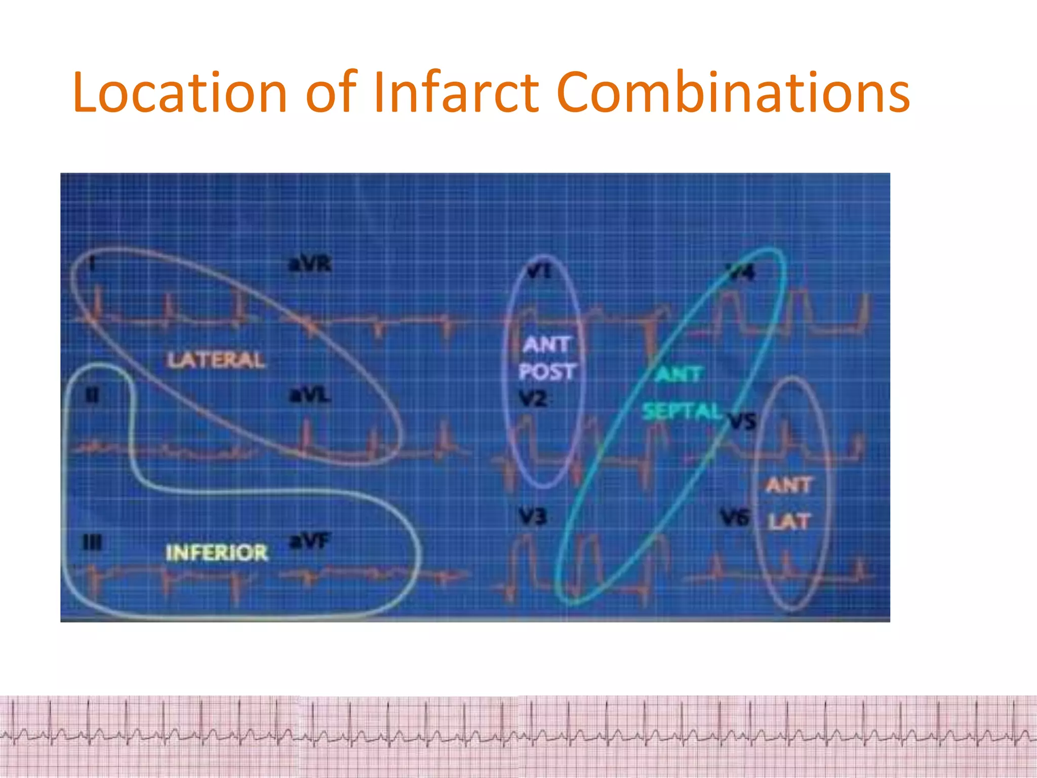 ECG Changes in Myocardial ischemia, myocardial infarction.pptx
