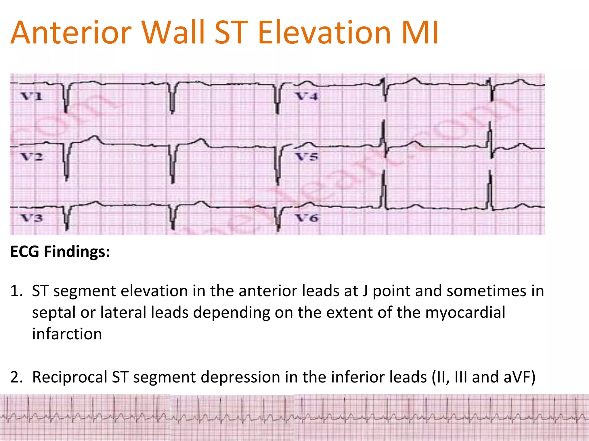 ECG Changes in Myocardial ischemia, myocardial infarction.pptx