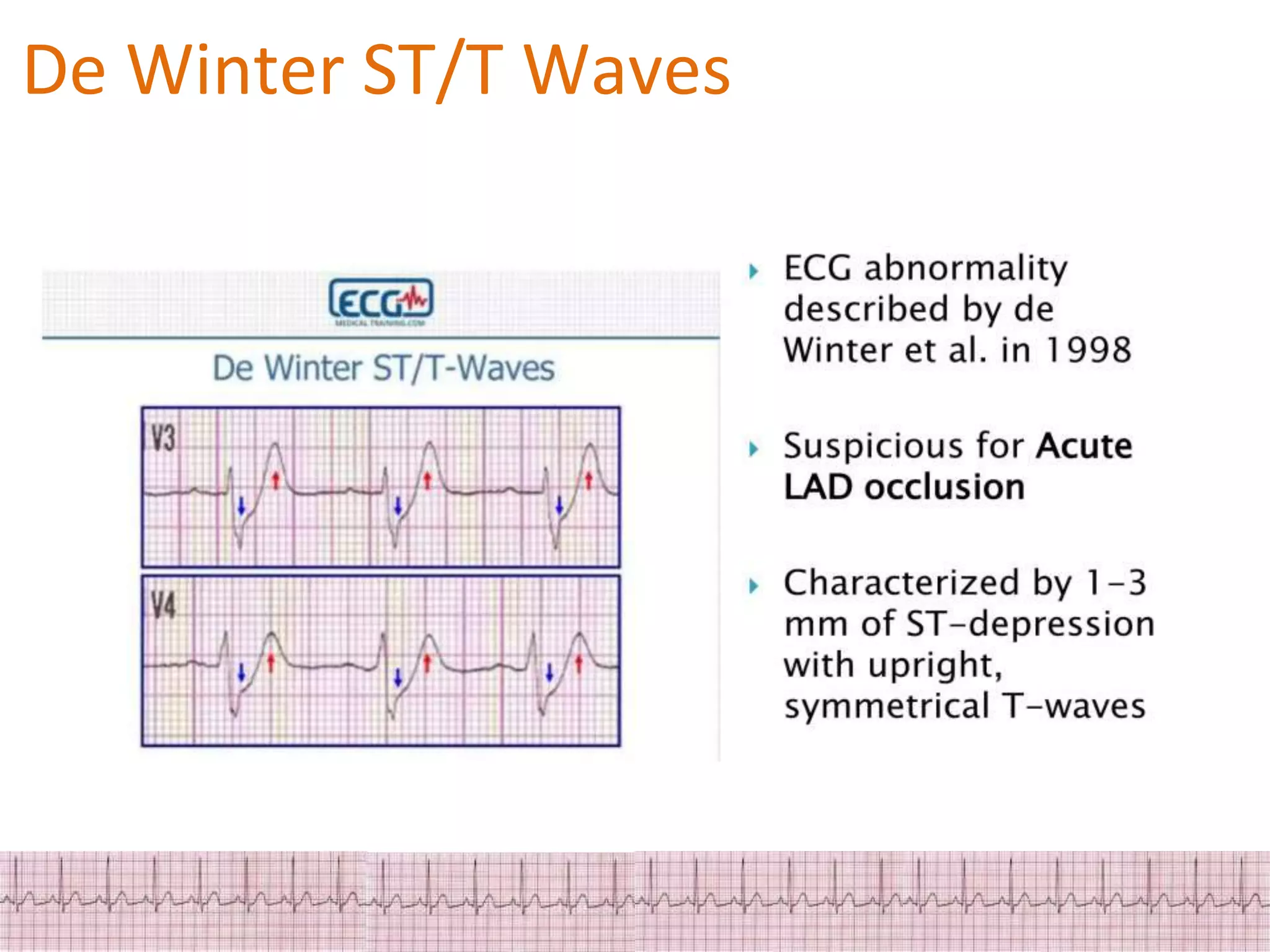 ECG Changes in Myocardial ischemia, myocardial infarction.pptx