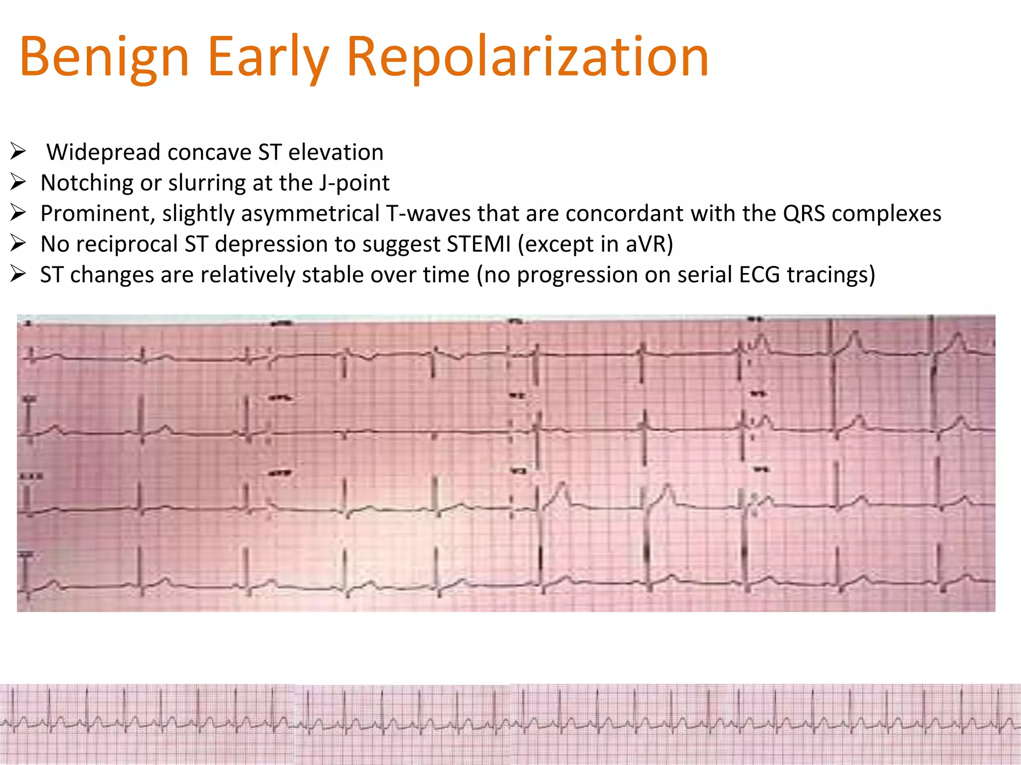 ECG Changes in Myocardial ischemia, myocardial infarction.pptx