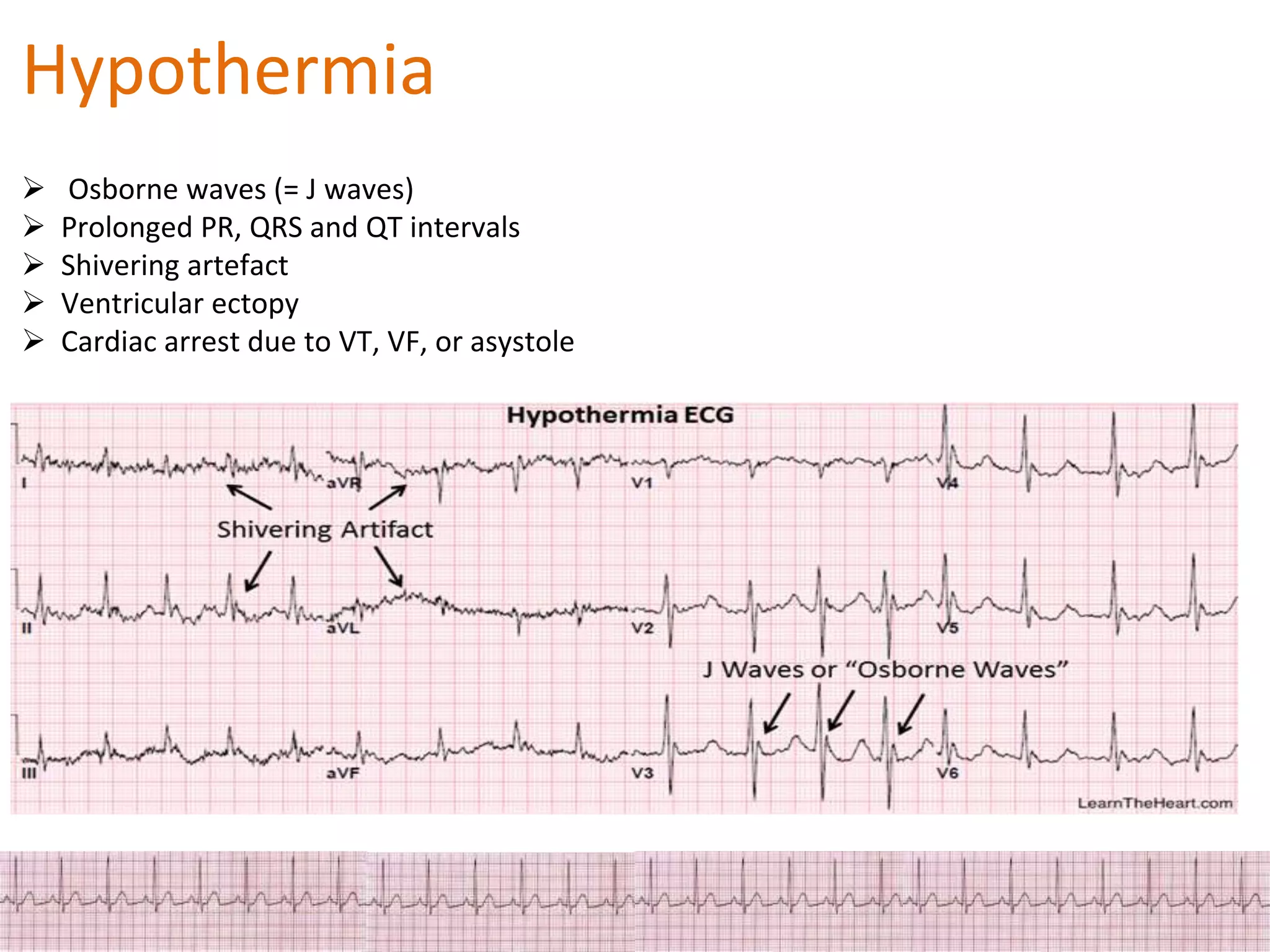 ECG Changes in Myocardial ischemia, myocardial infarction.pptx