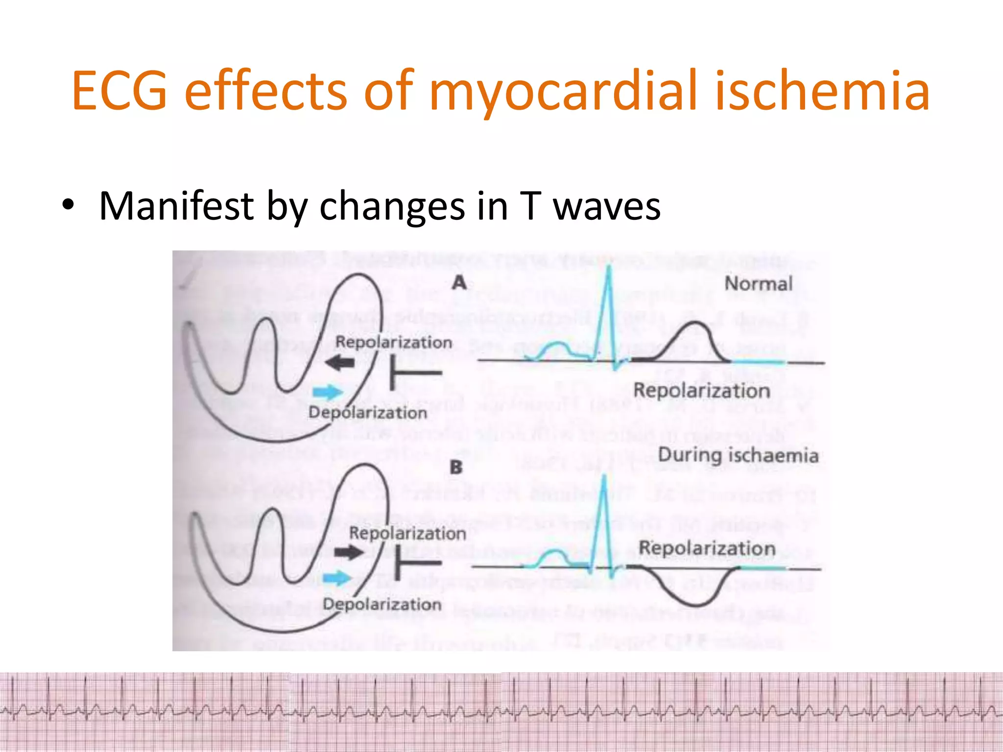 ECG Changes in Myocardial ischemia, myocardial infarction.pptx