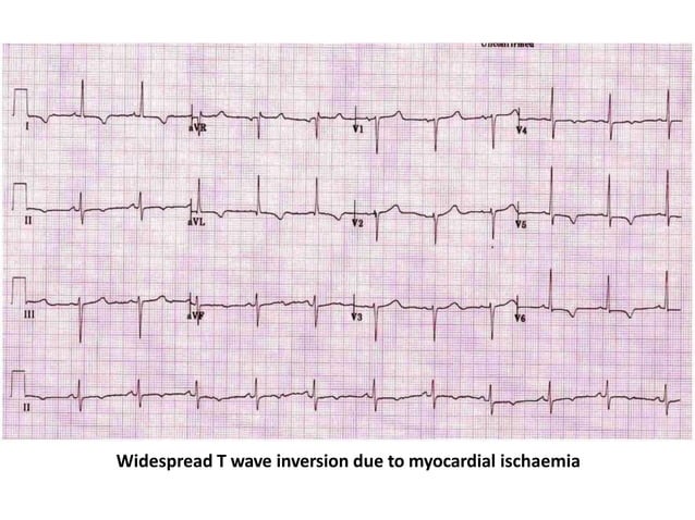 ECG Changes in Myocardial ischemia, myocardial infarction.pptx