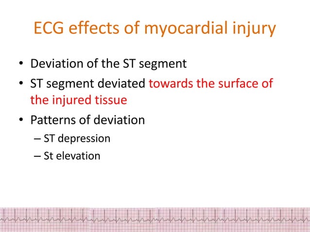 ECG Changes in Myocardial ischemia, myocardial infarction.pptx