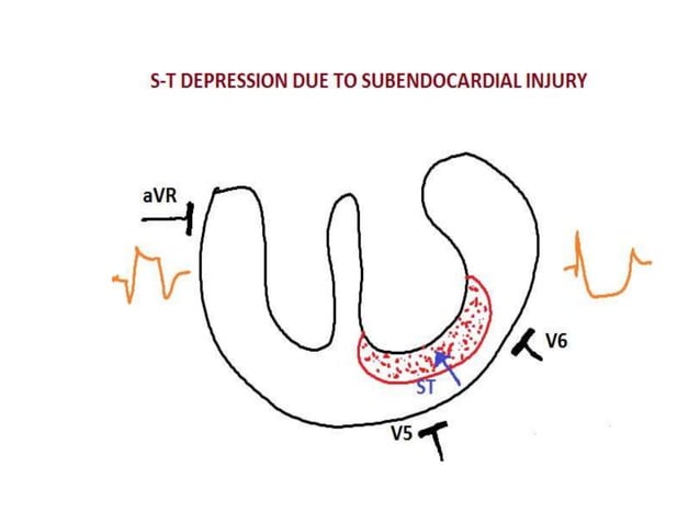 ECG Changes in Myocardial ischemia, myocardial infarction.pptx