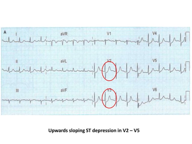 ECG Changes in Myocardial ischemia, myocardial infarction.pptx