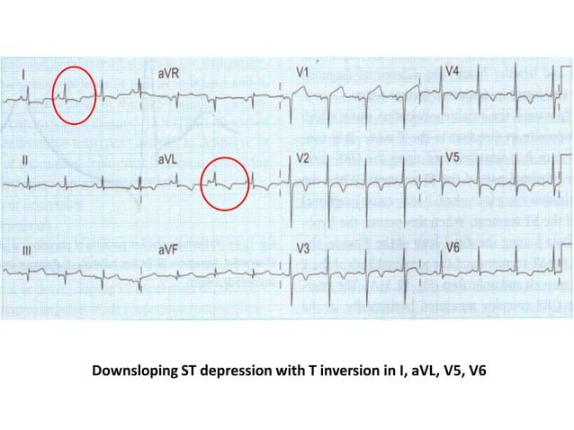 ECG Changes in Myocardial ischemia, myocardial infarction.pptx