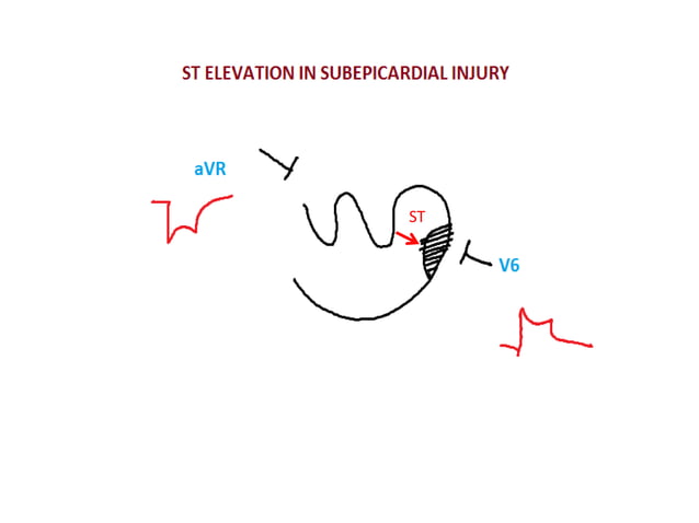 ECG Changes in Myocardial ischemia, myocardial infarction.pptx