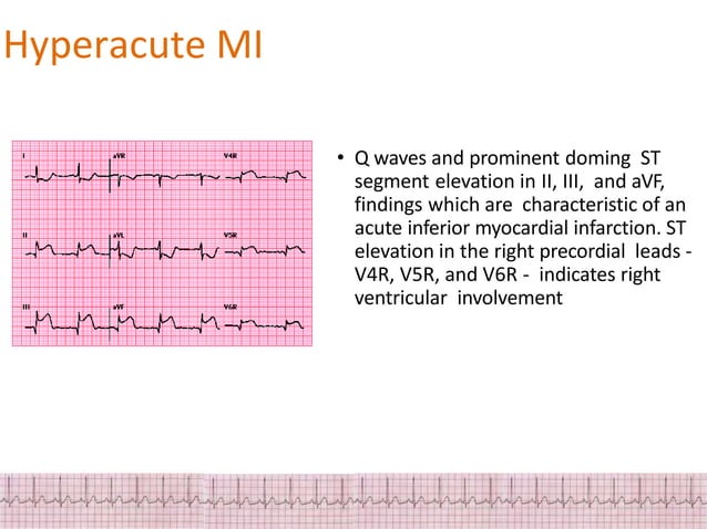 ECG Changes in Myocardial ischemia, myocardial infarction.pptx