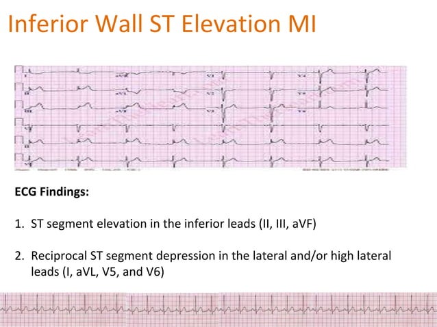 ECG Changes in Myocardial ischemia, myocardial infarction.pptx