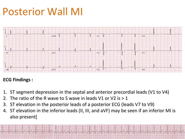 ECG Changes in Myocardial ischemia, myocardial infarction.pptx