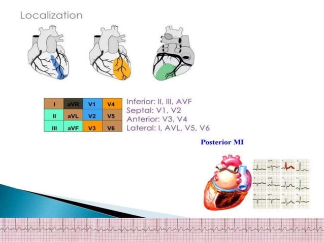 ECG Changes in Myocardial ischemia, myocardial infarction.pptx