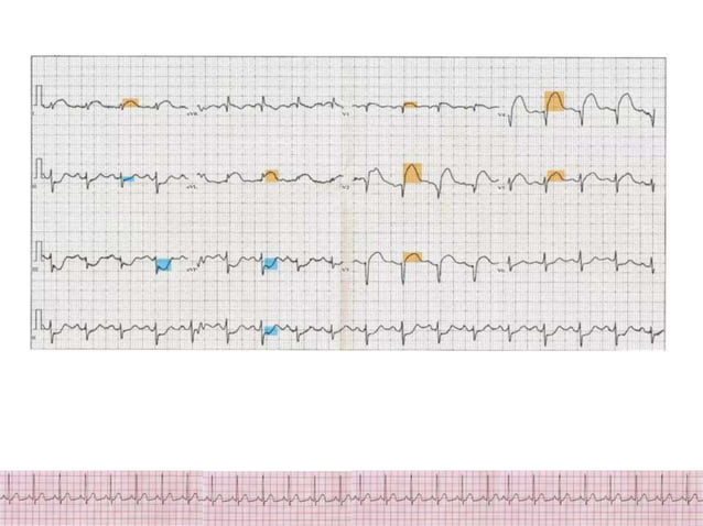 ECG Changes in Myocardial ischemia, myocardial infarction.pptx