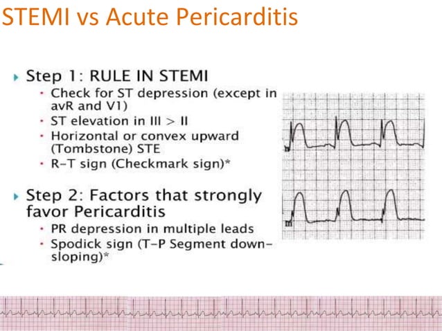 ECG Changes in Myocardial ischemia, myocardial infarction.pptx