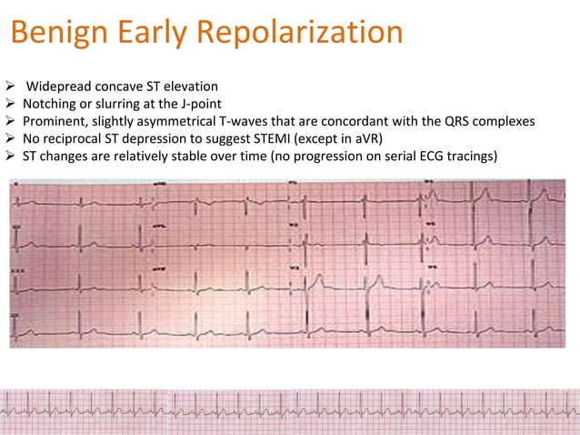 ECG Changes in Myocardial ischemia, myocardial infarction.pptx