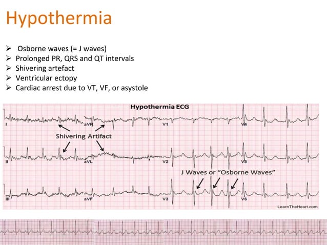 ECG Changes in Myocardial ischemia, myocardial infarction.pptx