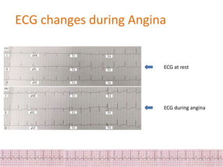 ECG Changes in Myocardial ischemia, myocardial infarction.pptx