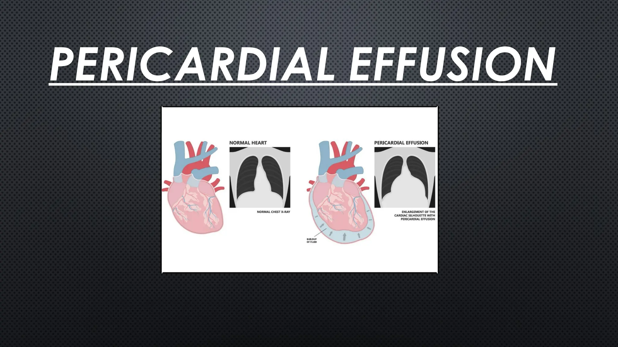 ecg changes in pericarditis and pleural effusion - Priyanshi Rastogi ...