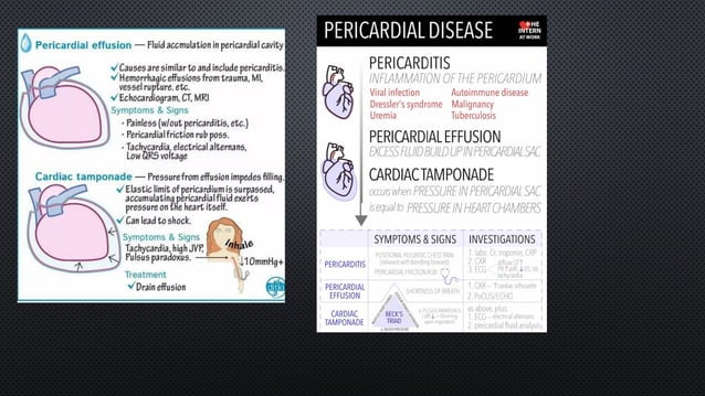 ecg changes in pericarditis and pleural effusion - Priyanshi Rastogi ...