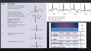 ecg changes in pericarditis and pleural effusion - Priyanshi Rastogi ...