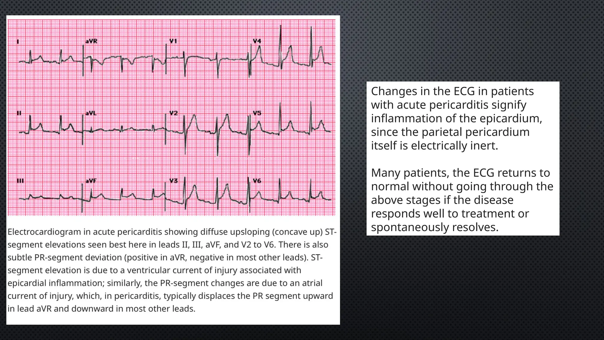 ecg changes in pericarditis and pleural effusion - Priyanshi Rastogi ...