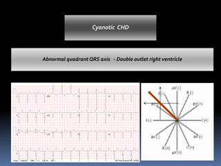 ECG& CHDs.pdf