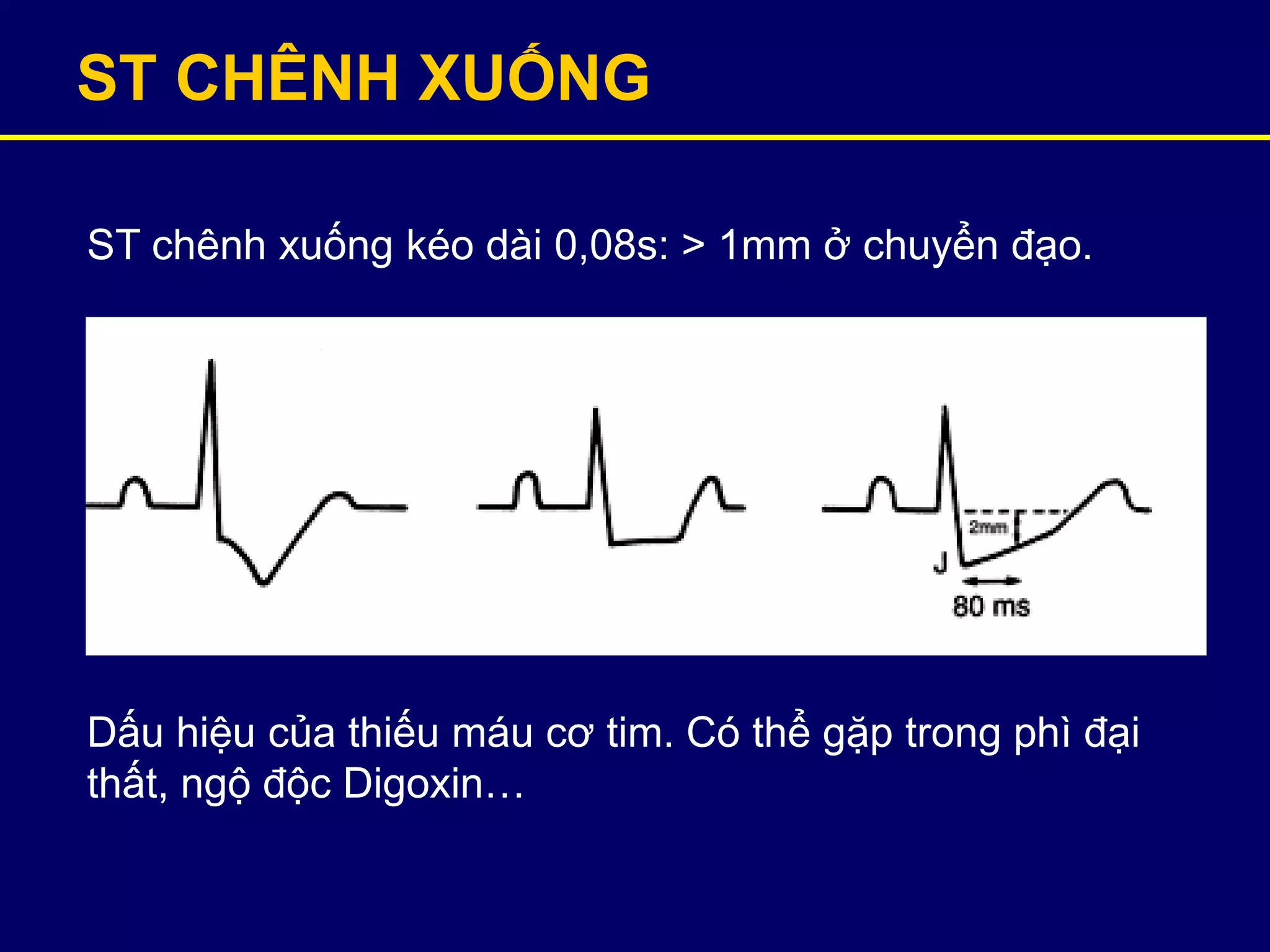 ECG CƠ BẢN | PDF