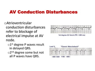 ECG complete lecture notes along with interpretation | PPTX