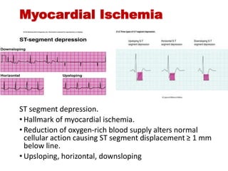 ECG complete lecture notes along with interpretation | PPTX