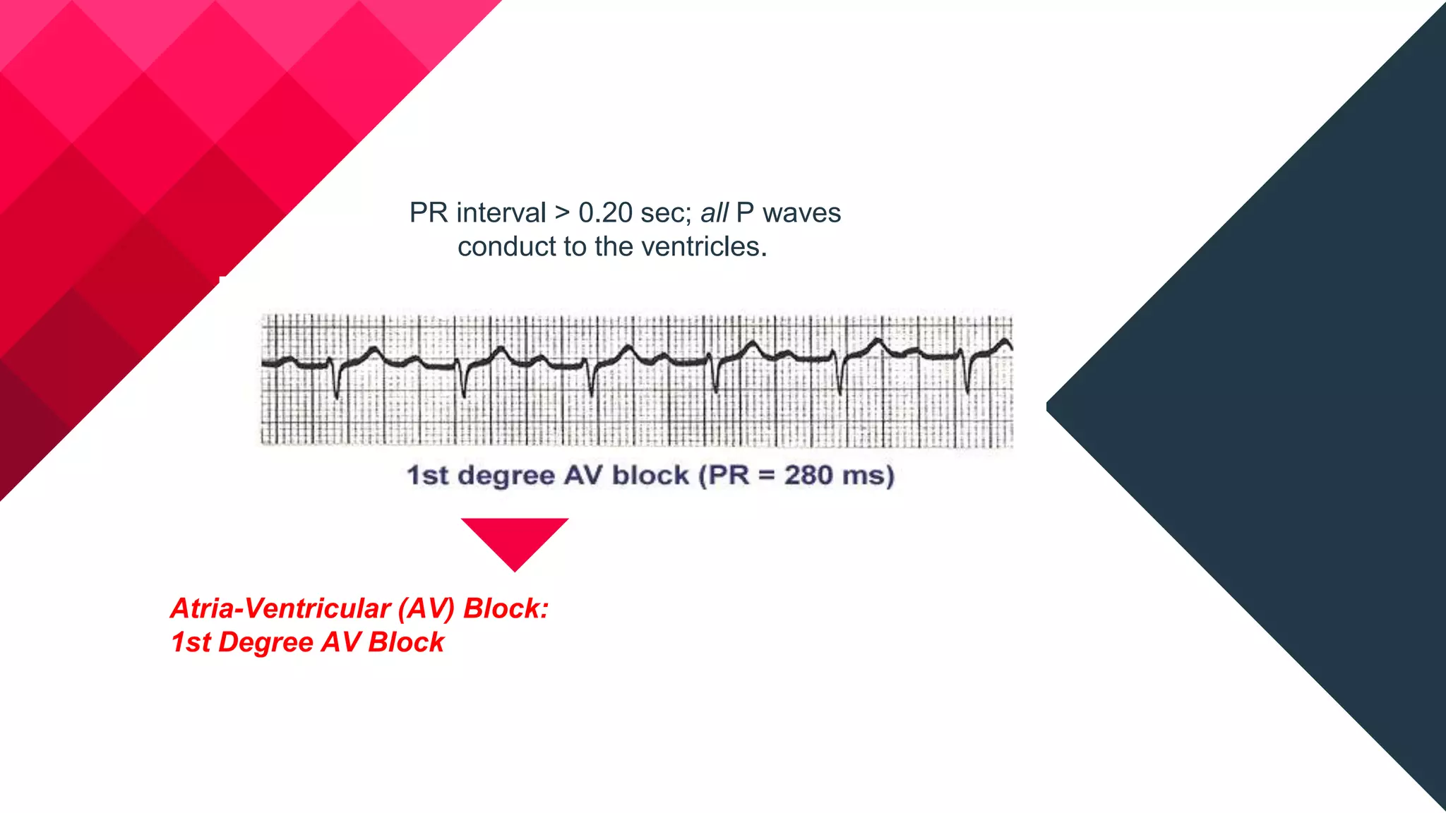 ECG Conduction Abnormalities | PPTX | Heart and Cardiovascular Diseases ...